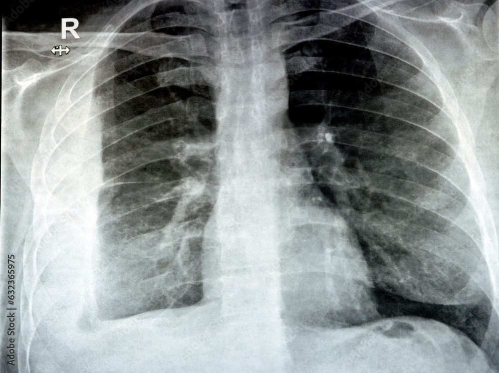 Plain X ray for a patient with aspiration pneumonia right lung, empyema ...