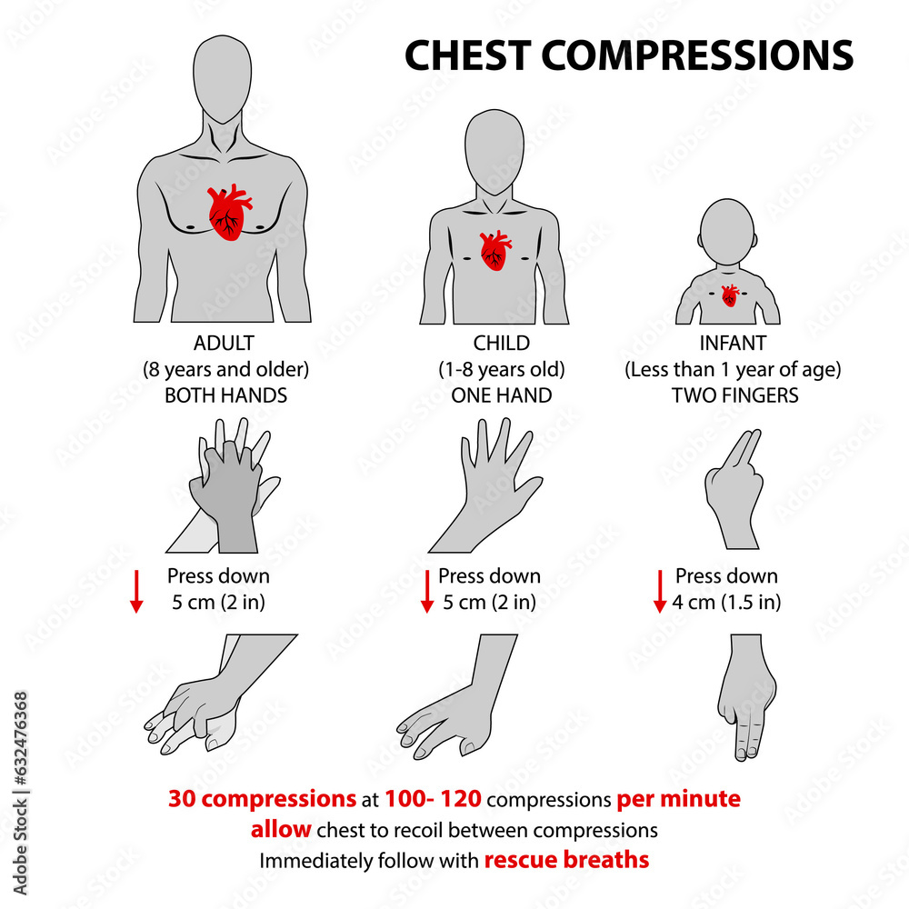 CPR chest compression Stock Illustration | Adobe Stock