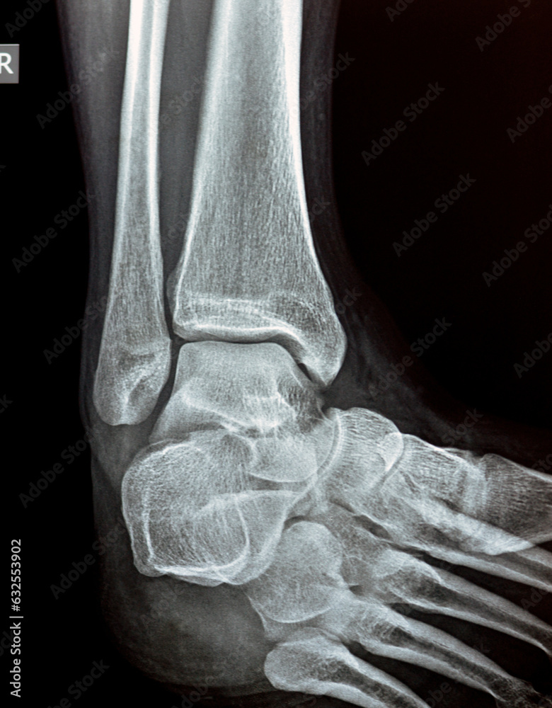 Plain x-ray mortise view of the right ankle showing syndesmotic ankle ...