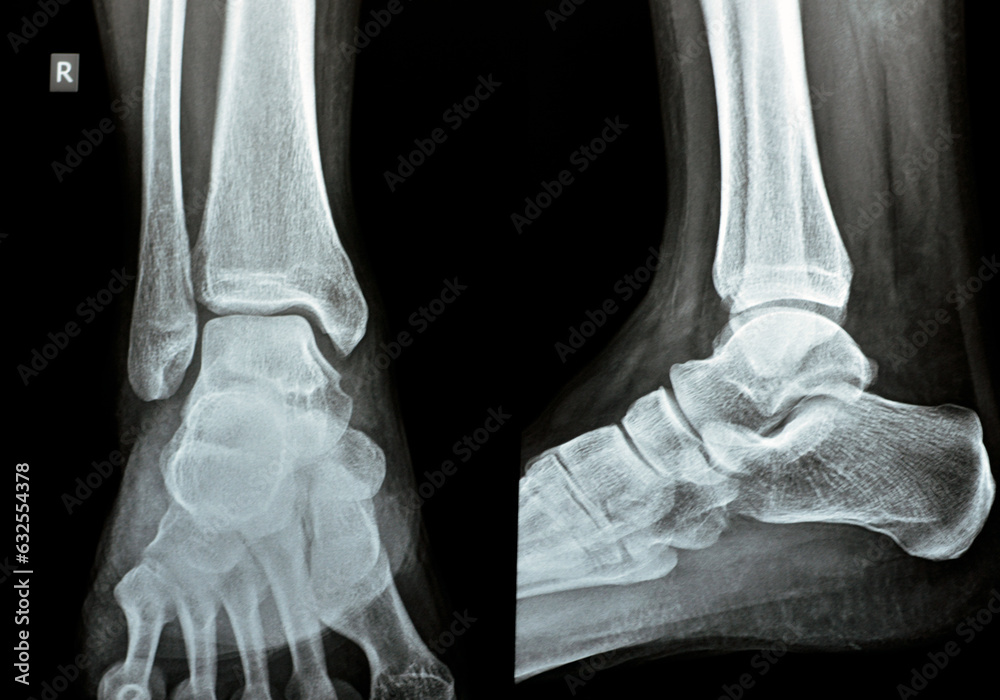 Plain x-ray AP Lateral views of the right ankle showing syndesmotic ...