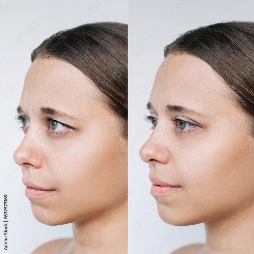 Young caucasian woman's face with drooping upper eyelid before and ...