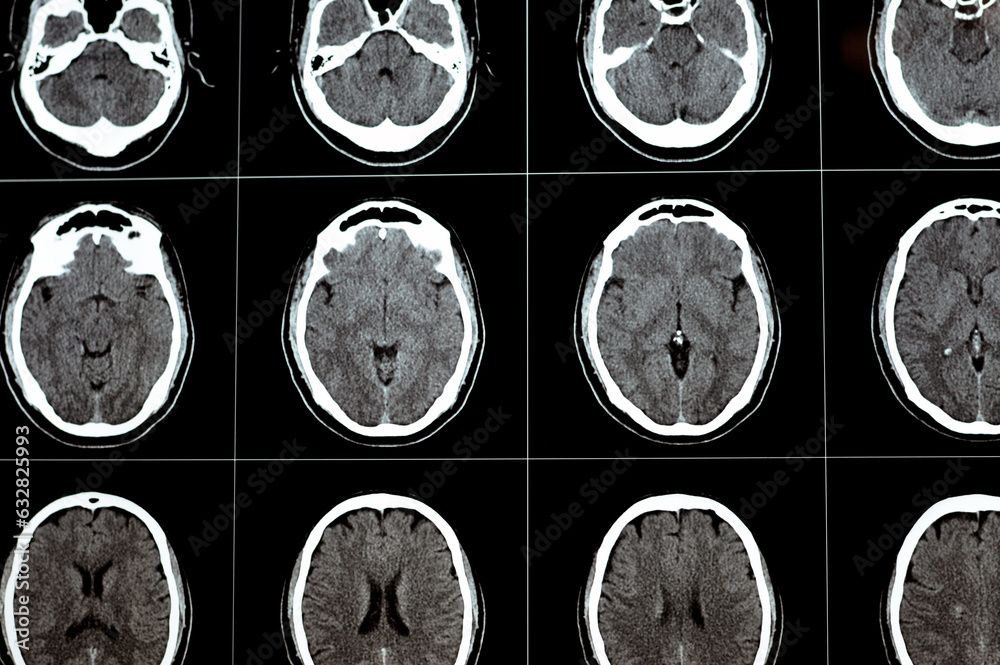 Brain CT scan showing brainstem cavernoma, right centrum semiovale ...