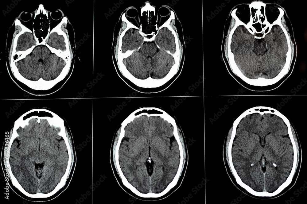 Brain CT scan showing brainstem cavernoma, right centrum semiovale ...