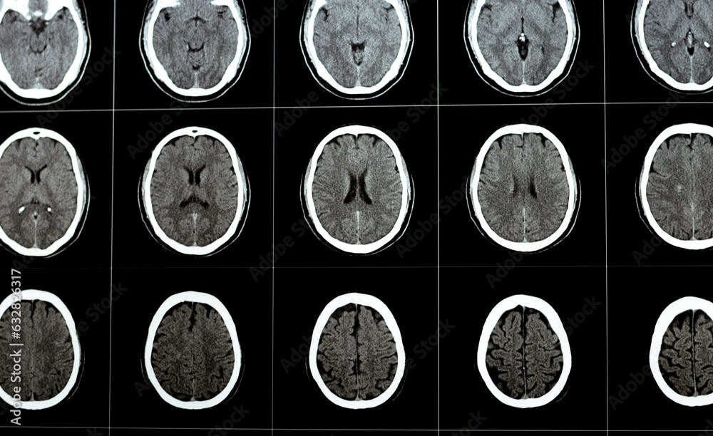 Photo & Art Print Brain CT scan showing brainstem cavernoma, right ...
