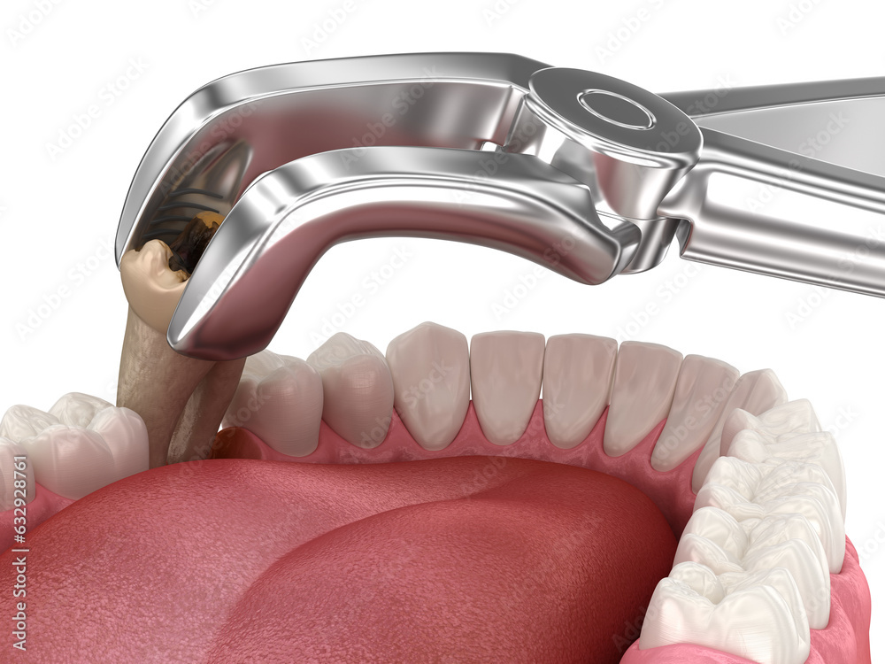 Extraction of Molar tooth damaged by caries. Dental 3D illustration ...