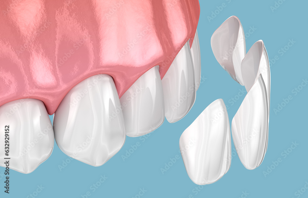 Dental veneer placement over frontal teeth. 3D illustration Stock ...