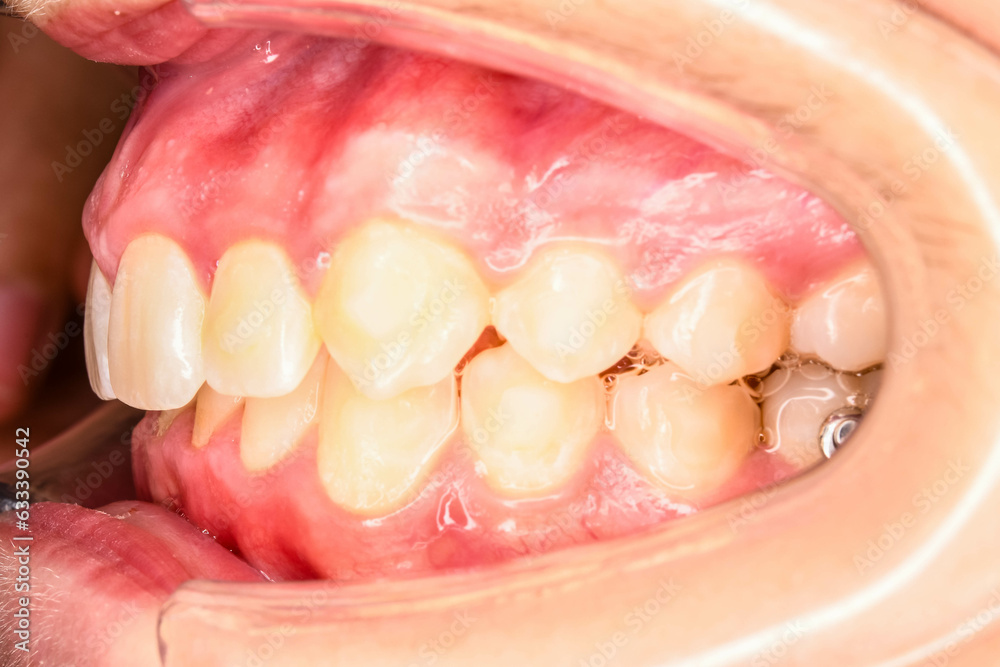 Intra oral photography of a maxillary arch in palatal view Stock Photo ...