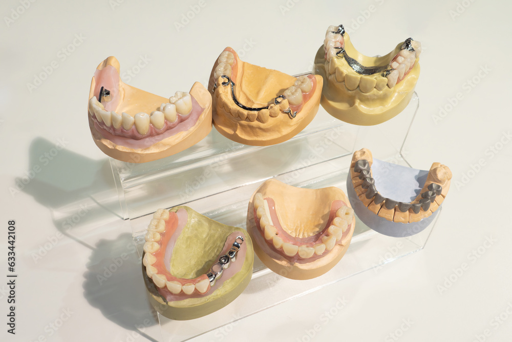 Models of dentures of different types. Jaw molds. Visual aid for ...