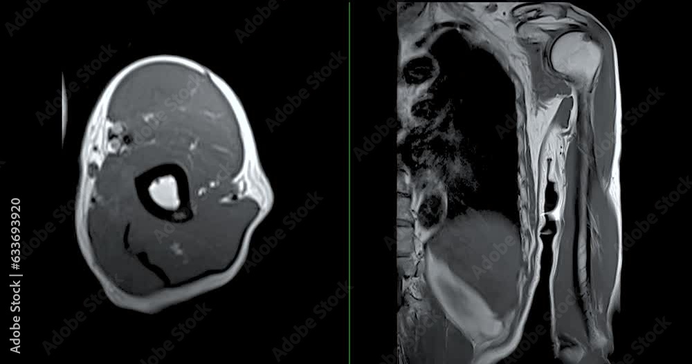 MRI Left humerus bone Axial and Coronal T2W for diagnosis bone tumor ...