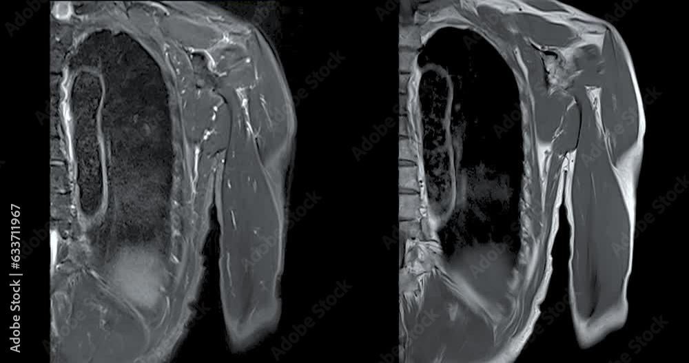 MRI Left humerus bone Coronal T2FS and T2W for diagnosis bone tumor ...