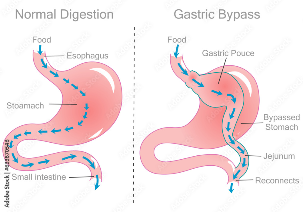 Gastric bypass surgery jejunum. Stomach reduction by pass, operation ...
