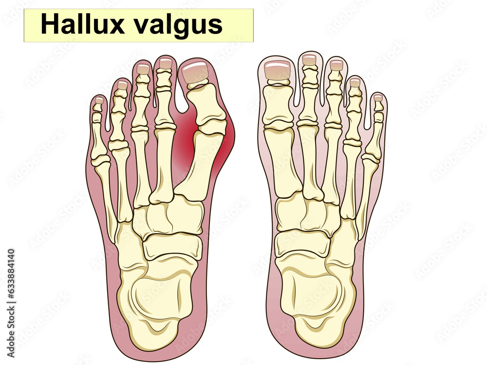 Hallux valgus. Anatomy. Human foot bones. Signatures, also for clinics ...