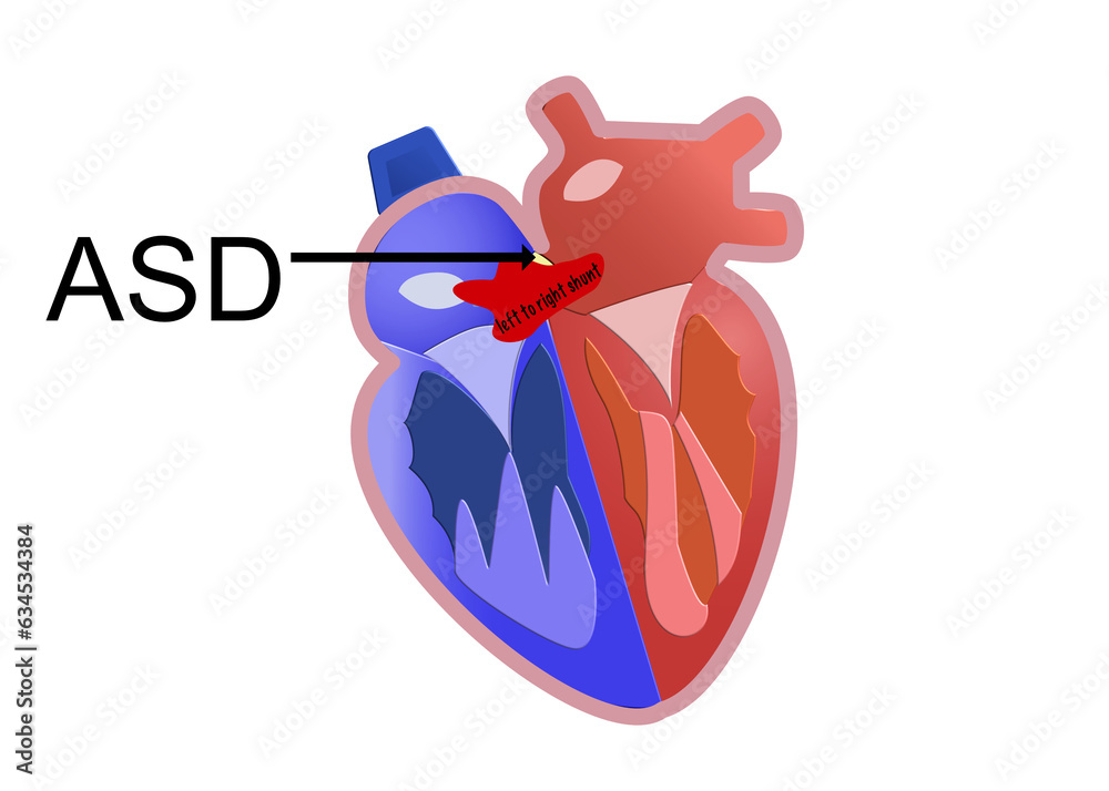 The picture shows atrial septal defect or ASD and the structure of left ...