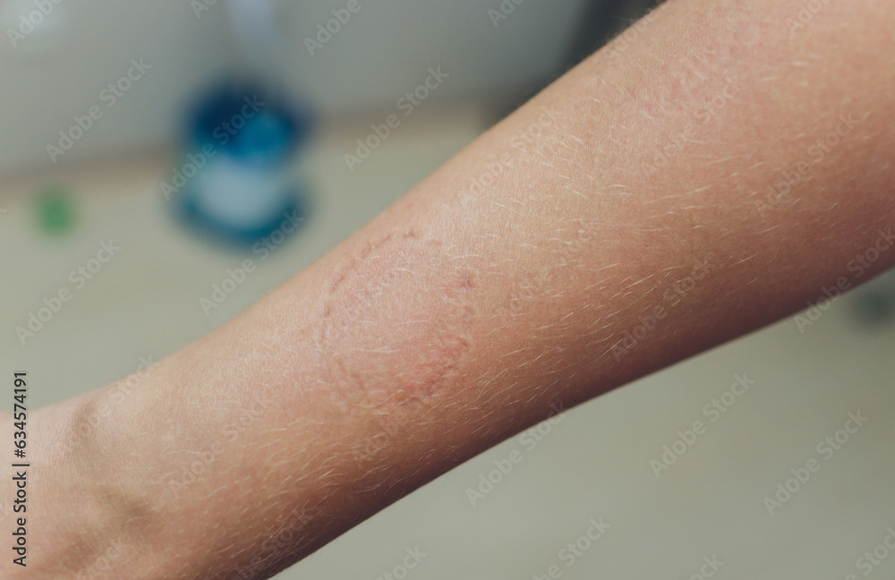 Toddler's bite marks on mothers arm - aggressive toddlers behavior ...