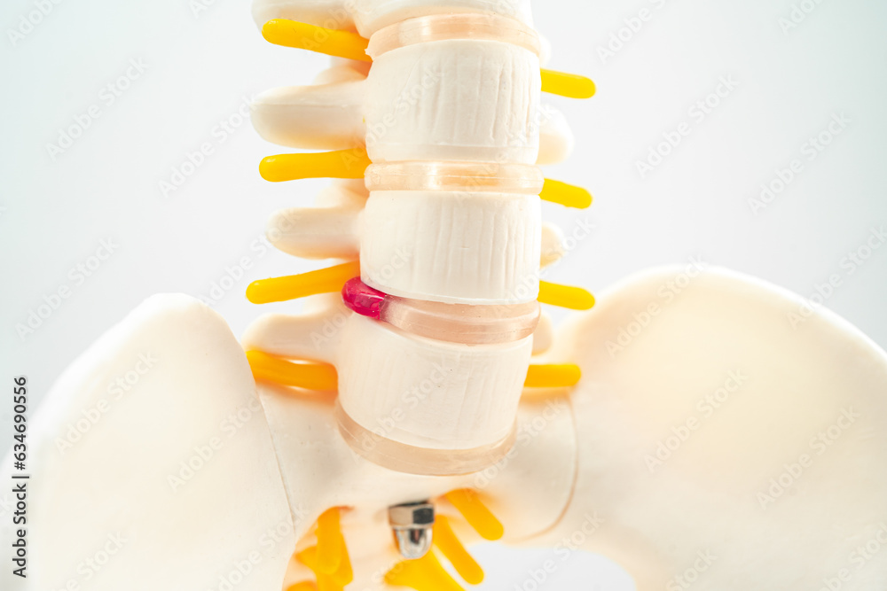 Lumbar spine displaced herniated disc fragment, spinal nerve and bone ...