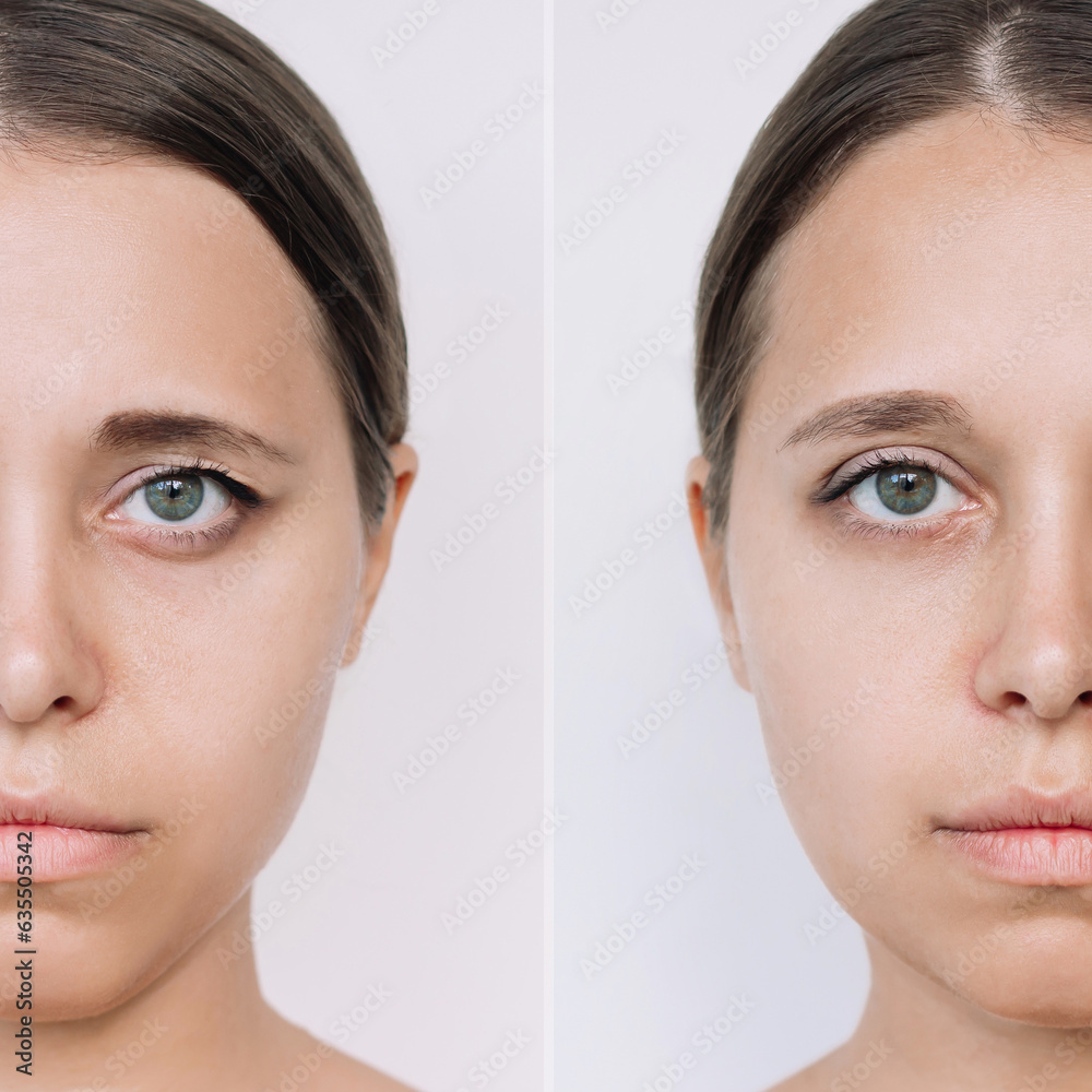 Young caucasian woman's face with drooping upper eyelid before and ...