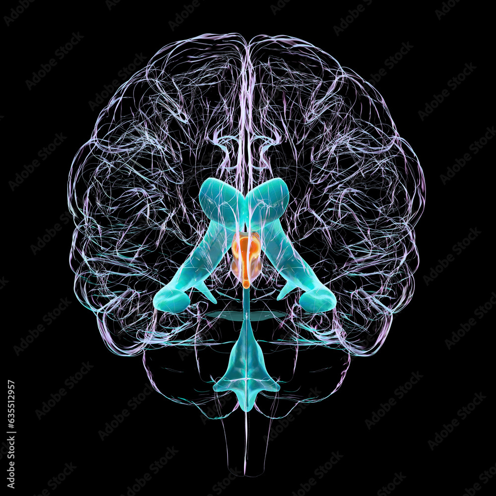 Enlarged third ventricle of the brain, 3D illustration Stock ...