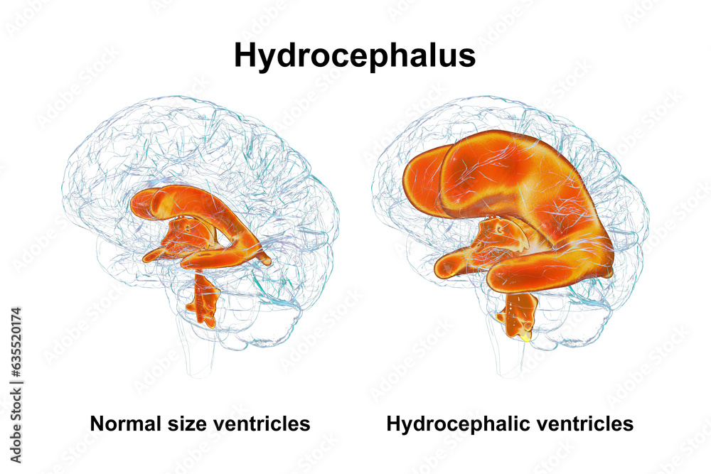 Poster Enlarged ventricles of the child brain and normal ventricular ...