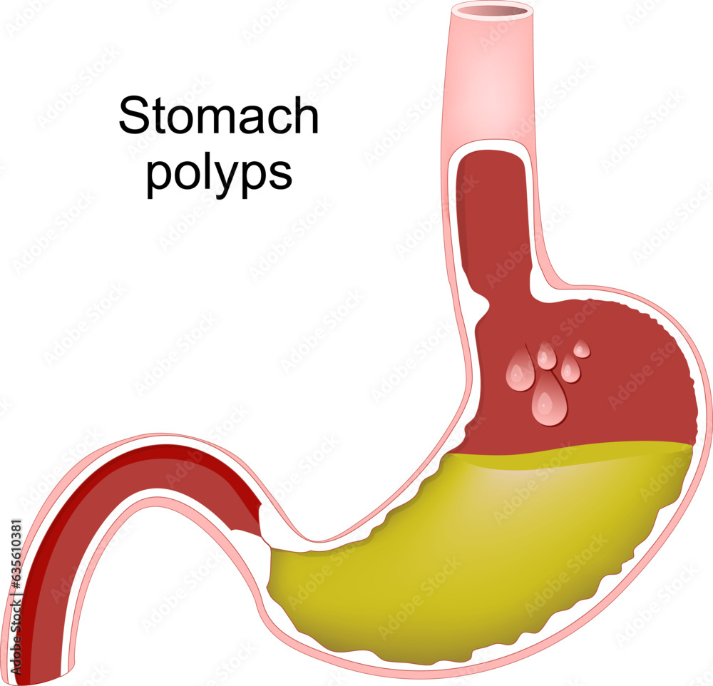 Póster Stomach polyps. Cross section of human stomach with Gastric ...