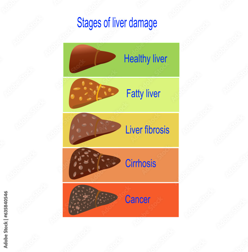 Stages of liver damage infographic concept , vector illustration Stock ...