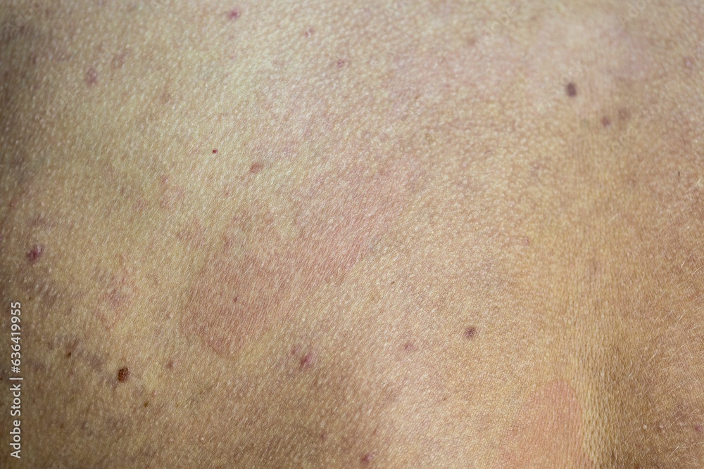 Man suffering from the skin condition Tinea Versicolor with discolored ...