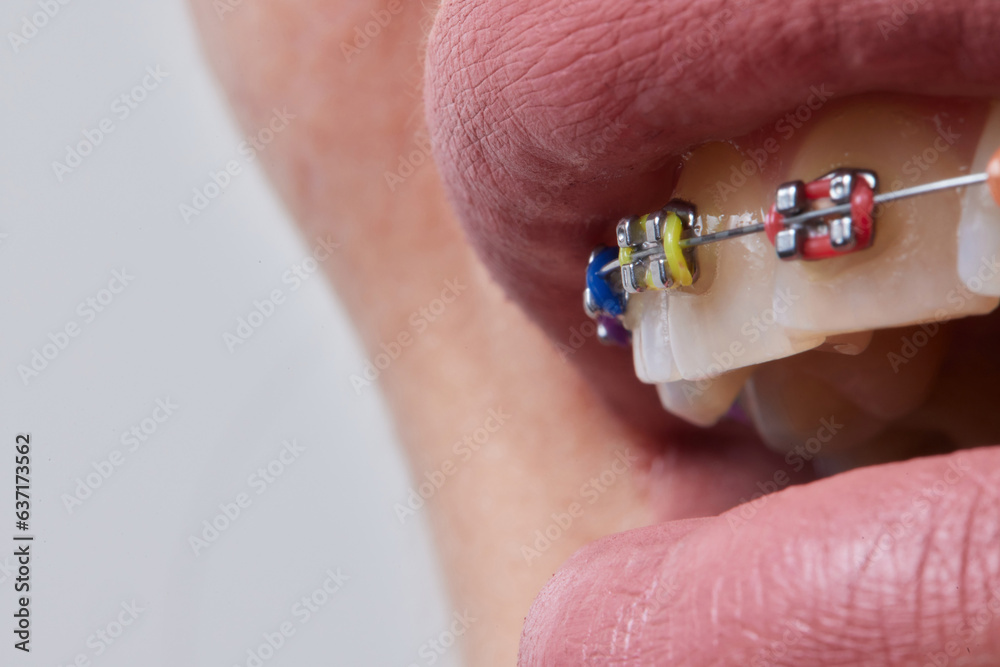 Dental procedure for installing braces close up.The procedure for the ...
