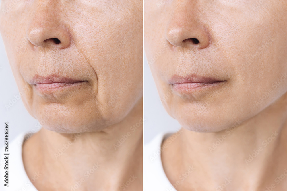 Lower part of elderly woman's face and neck with signs of skin aging ...