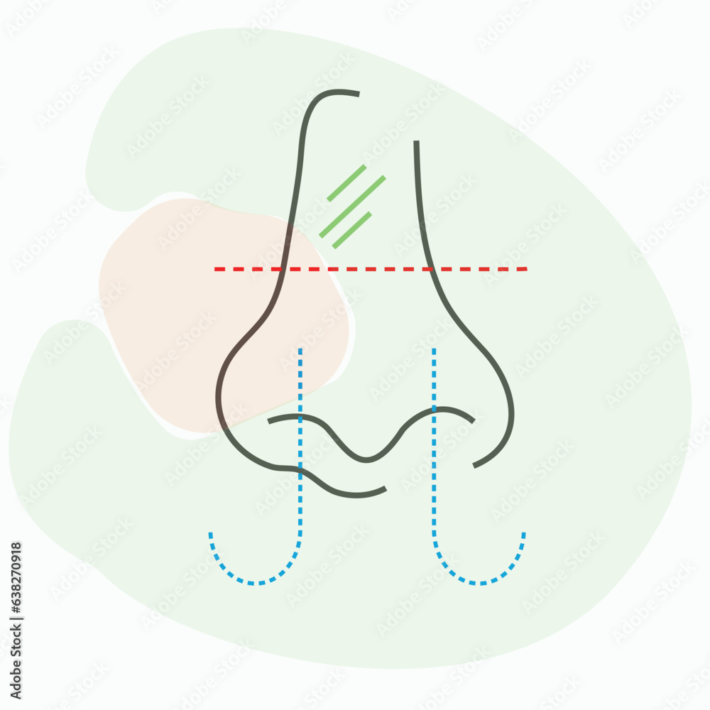 Nasal obstruction is when the nasal passages are blocked, or there is ...