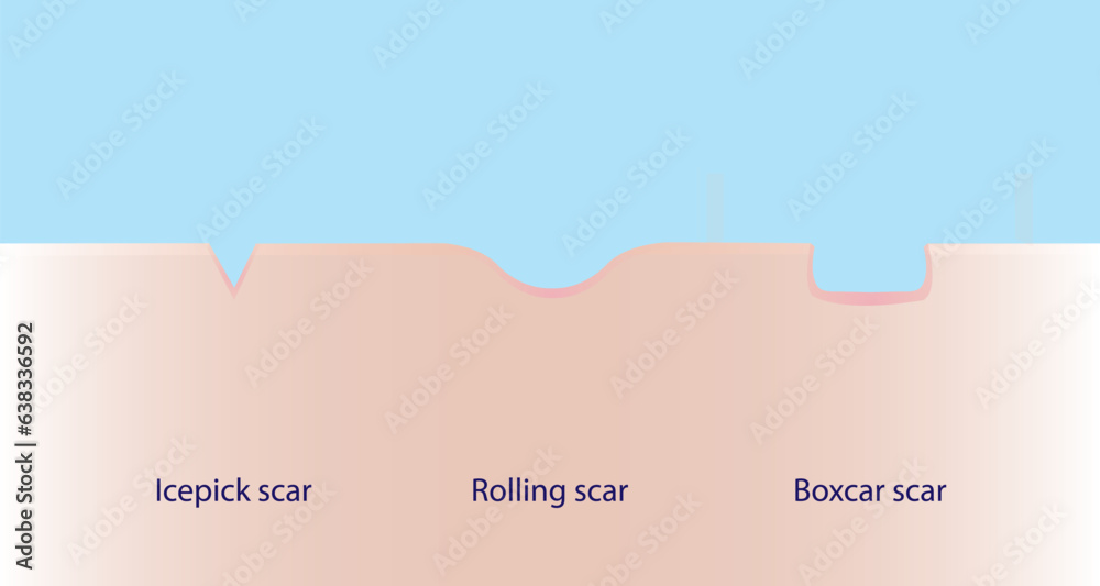 Types of acne scar vector on sky blue background. Icepick scar, rolling ...
