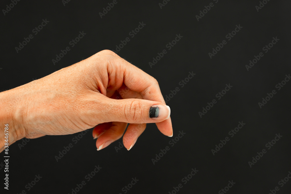 Subungual hematoma present under the toenail of the hallux, more ...