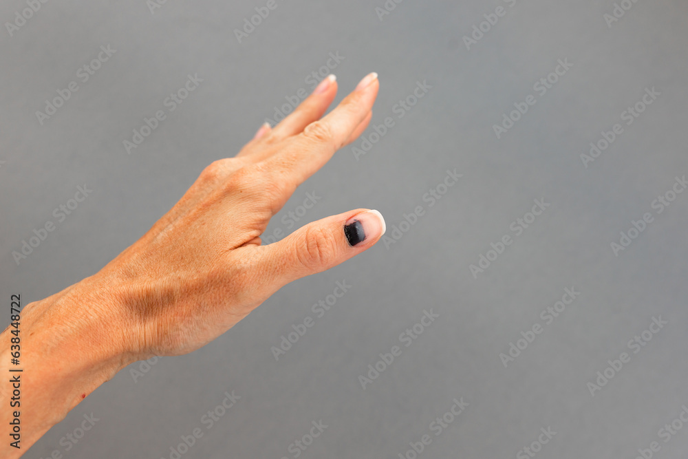 Subungual hematoma present under the toenail of the hallux, more ...