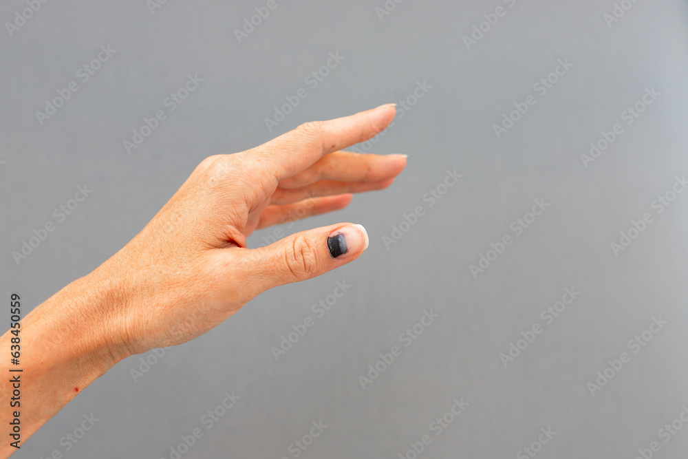 Subungual hematoma present under the toenail of the hallux, more ...