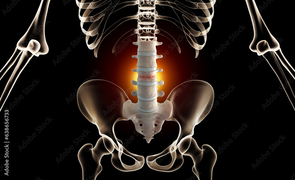 Lumbar compression fracture injury on x-ray skeleton Stock Illustration ...