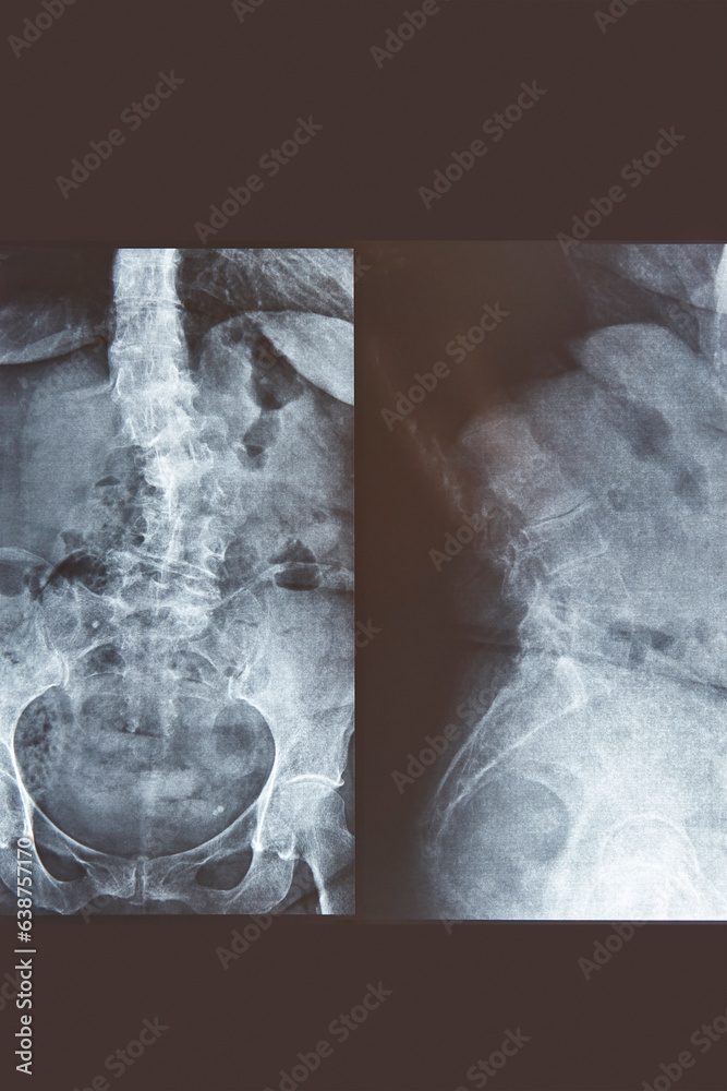 Lumbar spine xray. Front and lateral view. Healthcare. Examination ...