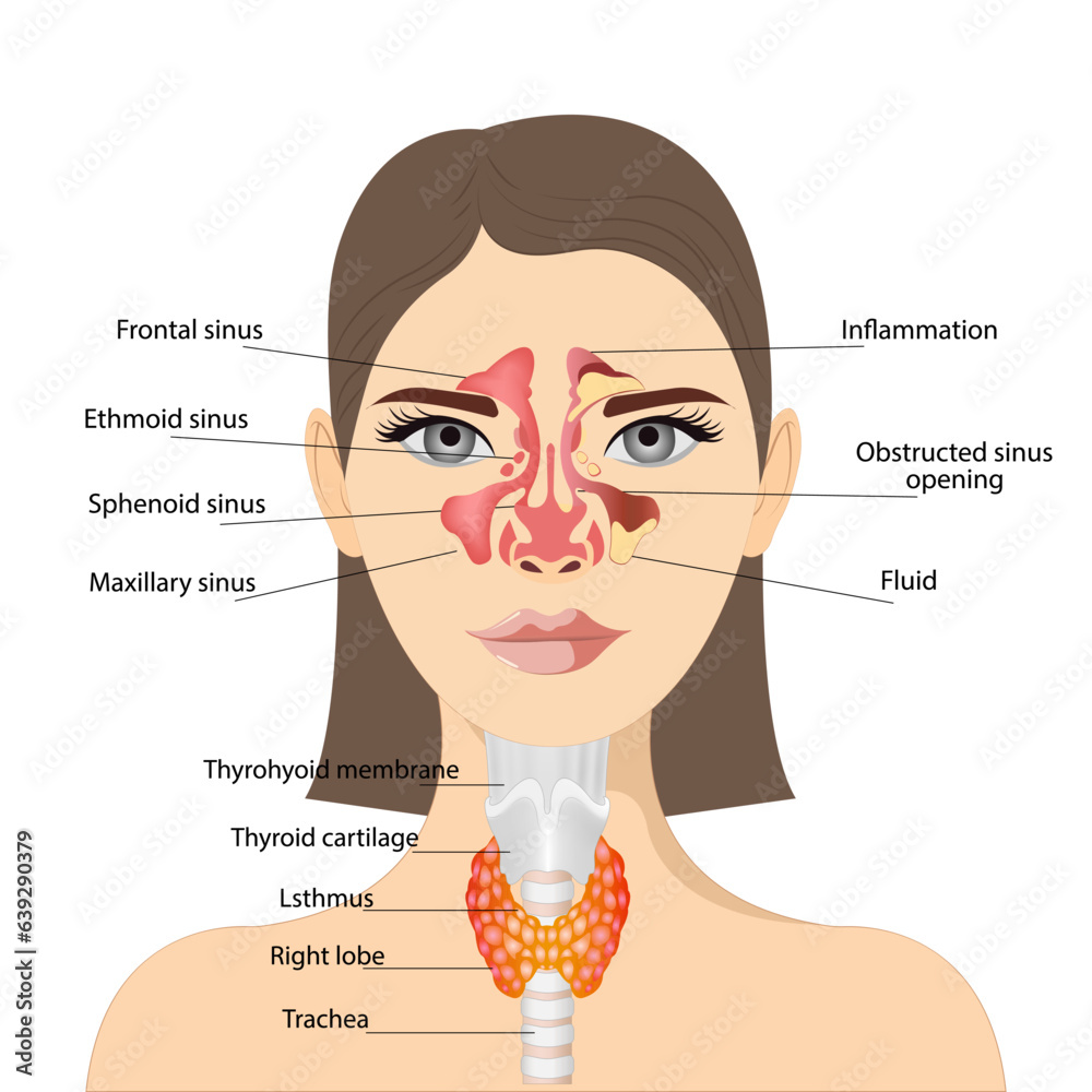 Sinusitis, Woman's face with inflammation of the mucous membrane of the ...