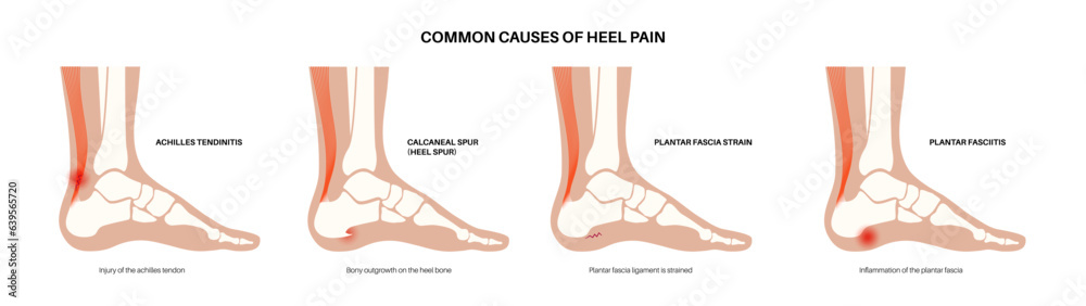 Heel pain diagram Stock Vector | Adobe Stock