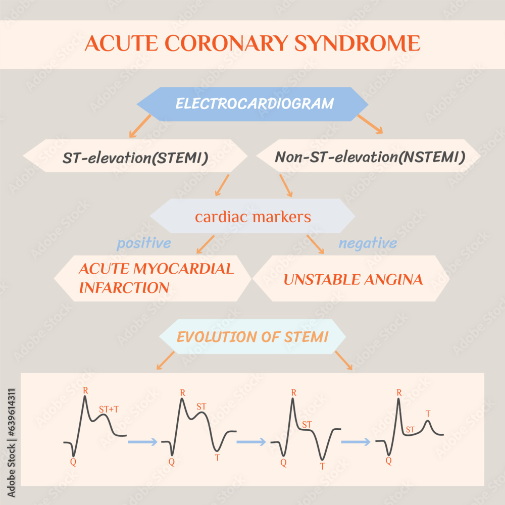 Acute coronary syndrome. Schematic Electrocardiogram of myocardial ...