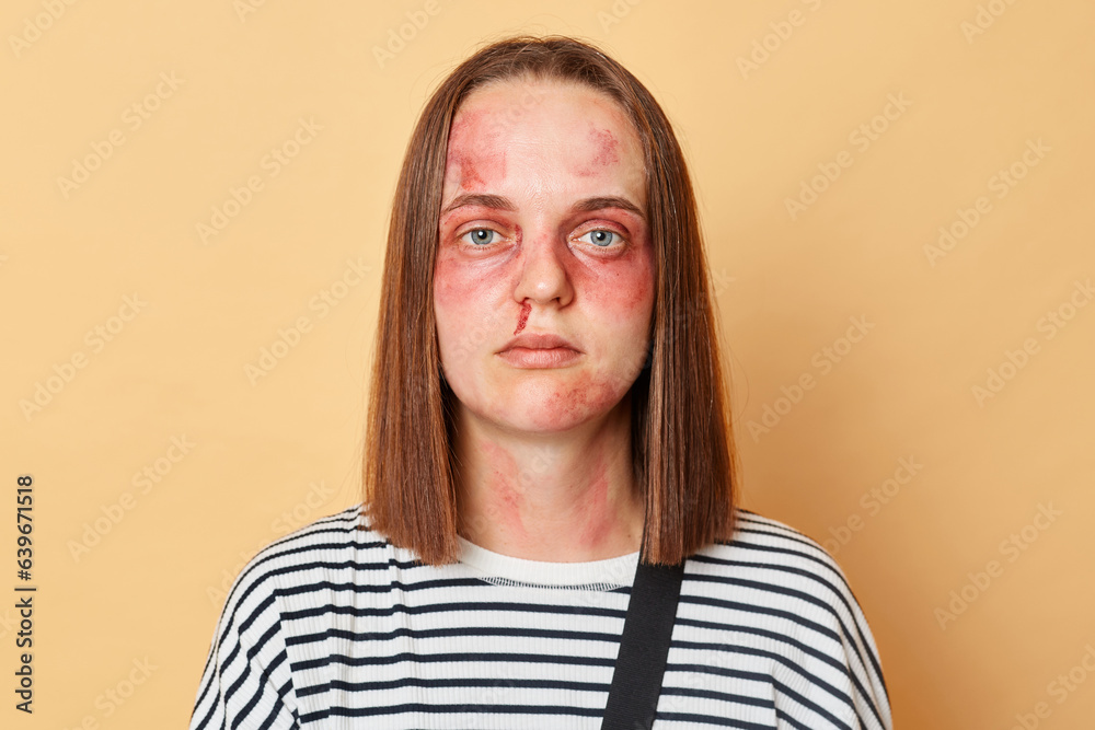 Serious confident woman in striped shirt with bruised skin standing ...