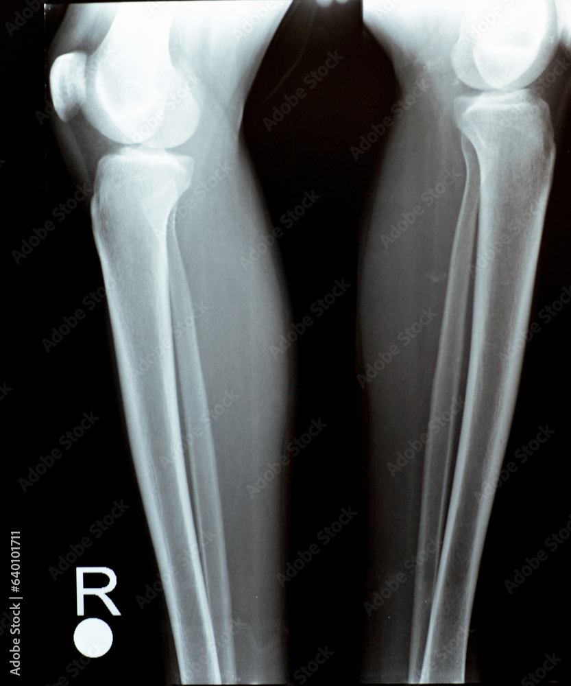 Plain X ray of both right and left knee joints with lower part of femur ...