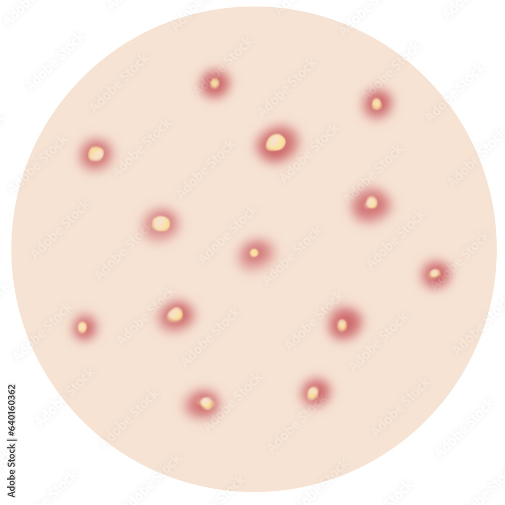 hand-drawn illustration of acne type. whiteheads, inflamed pimples ...