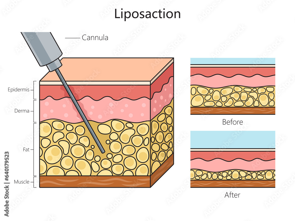 Liposuction lipo fat removal procedure diagram schematic raster illustration. Medical science ...