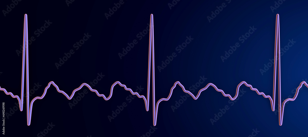 ECG in atrial flutter, 3D illustration Stock Illustration | Adobe Stock