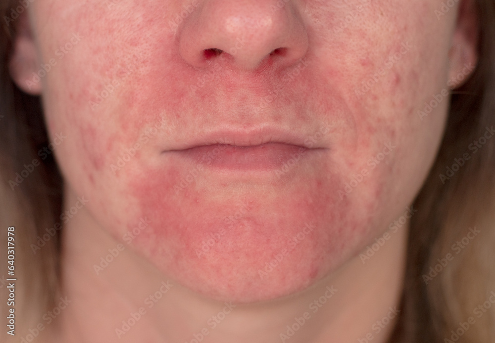 Seborrheic Dermatitis In the face of a young girl. Acne vulgaris and ...