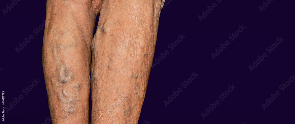 Varicose veins on a female legs. Phlebology and DVT. The old age and ...
