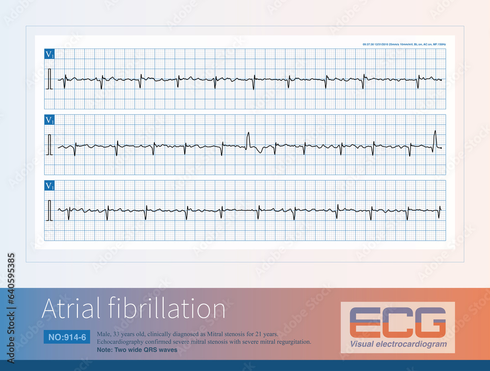 Male, 33 years old, clinically diagnosed with mitral stenosis. The ...