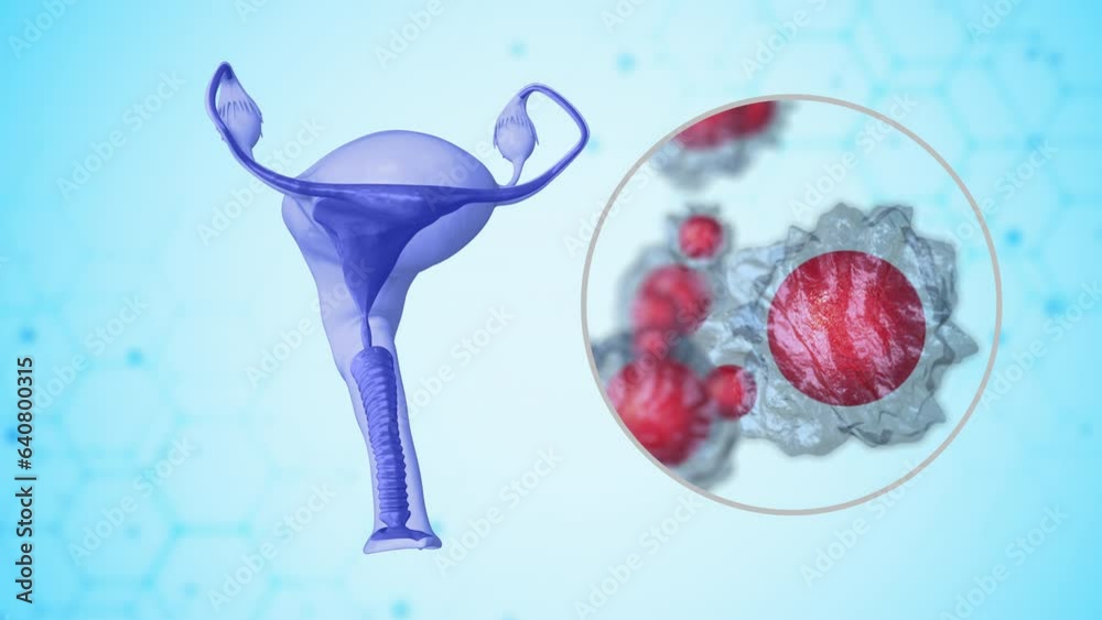 The female reproductive system's infected ovaries Stock Video | Adobe Stock