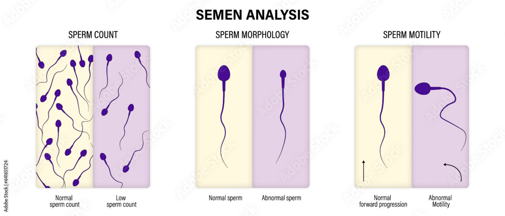 Semen analysis. Sperm count, morphology and motility. Male sperm ...