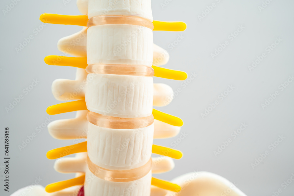 Lumbar spine displaced herniated disc fragment, spinal nerve and bone ...