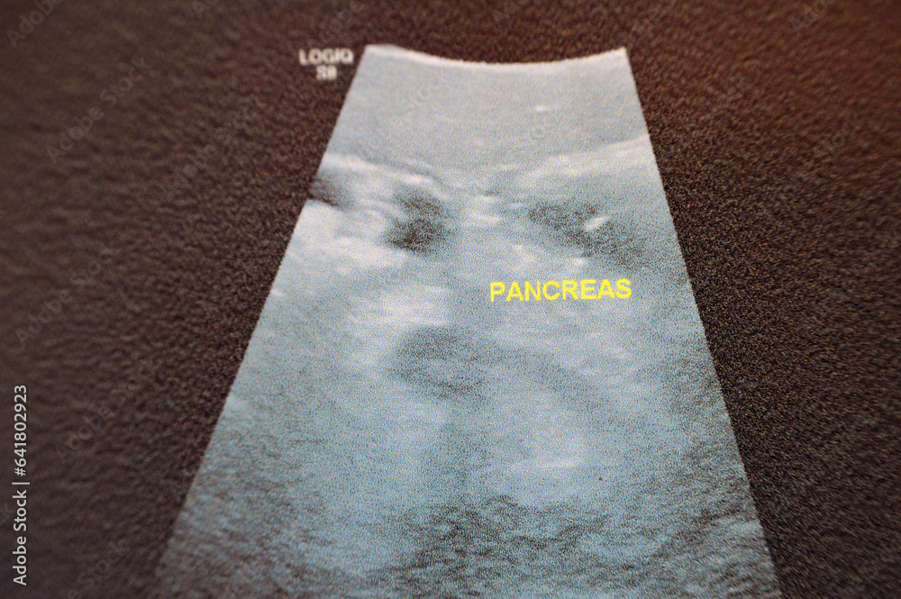 Pelviabdominal ultrasonography for female patient showing normal ...