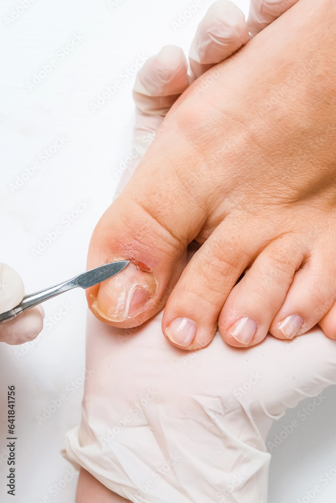 Pedicure, podologist. Patient on medical pedicure procedure, nail ...